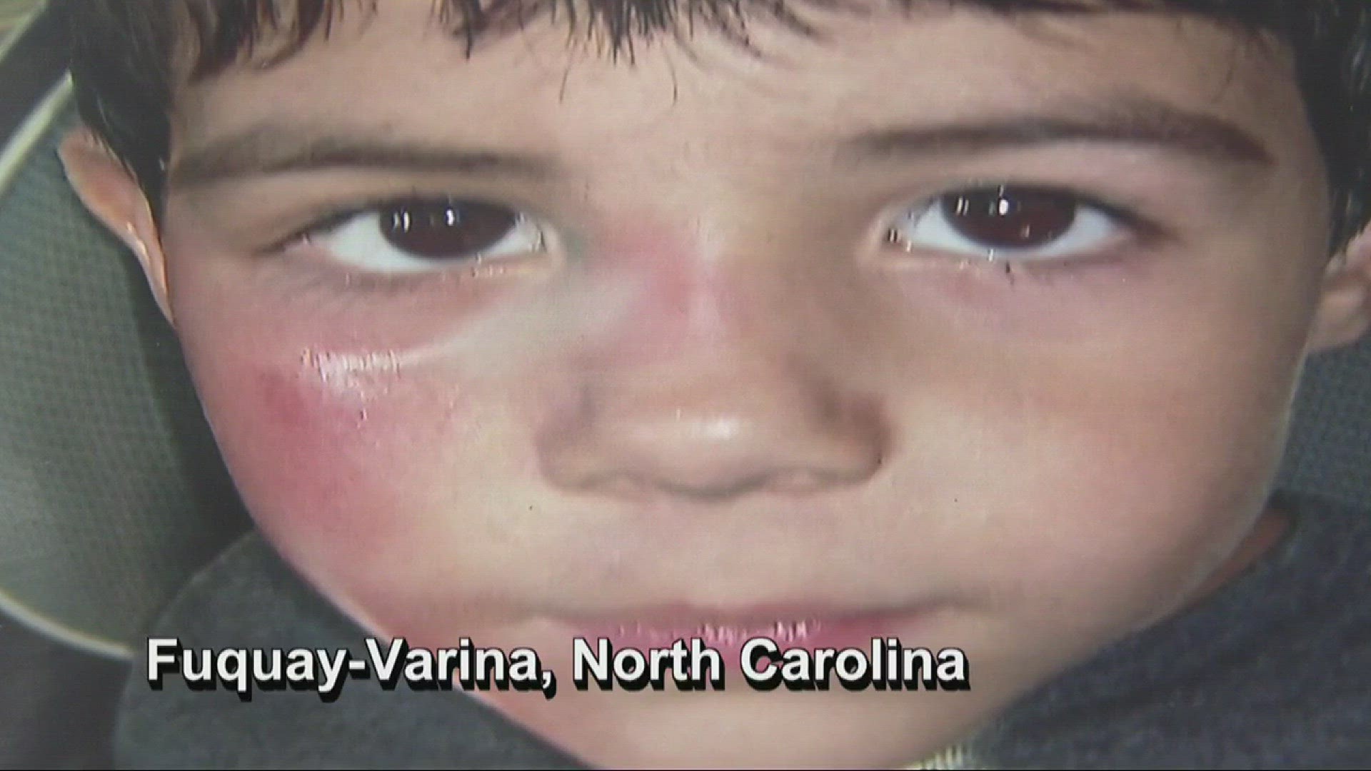 Daycare denies scarring 4-year-old boy's face | 12news.com