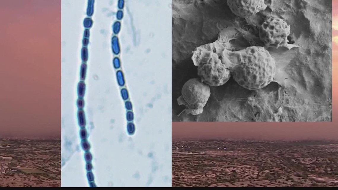 Here’s what you need to know about Arizona’s Valley fever | 12news.com
