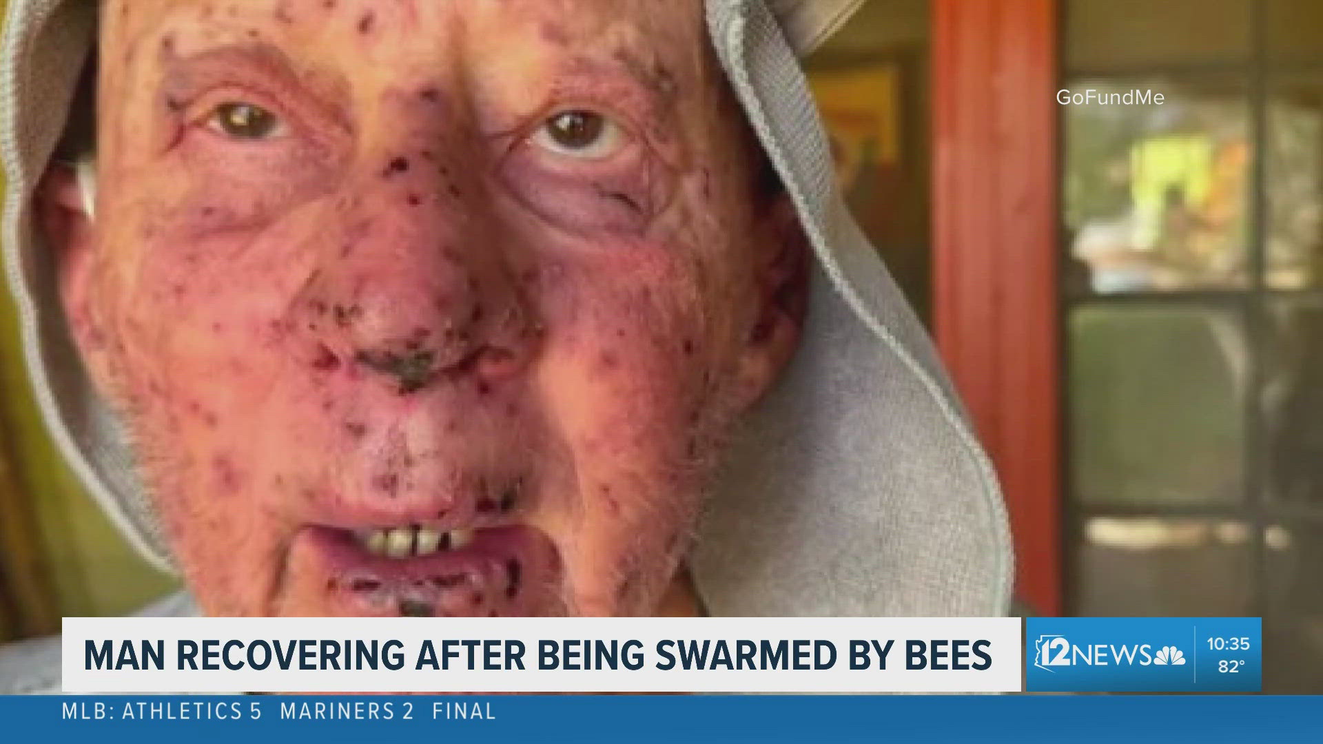 Man recovering after being stung by a bee swarm | 12news.com