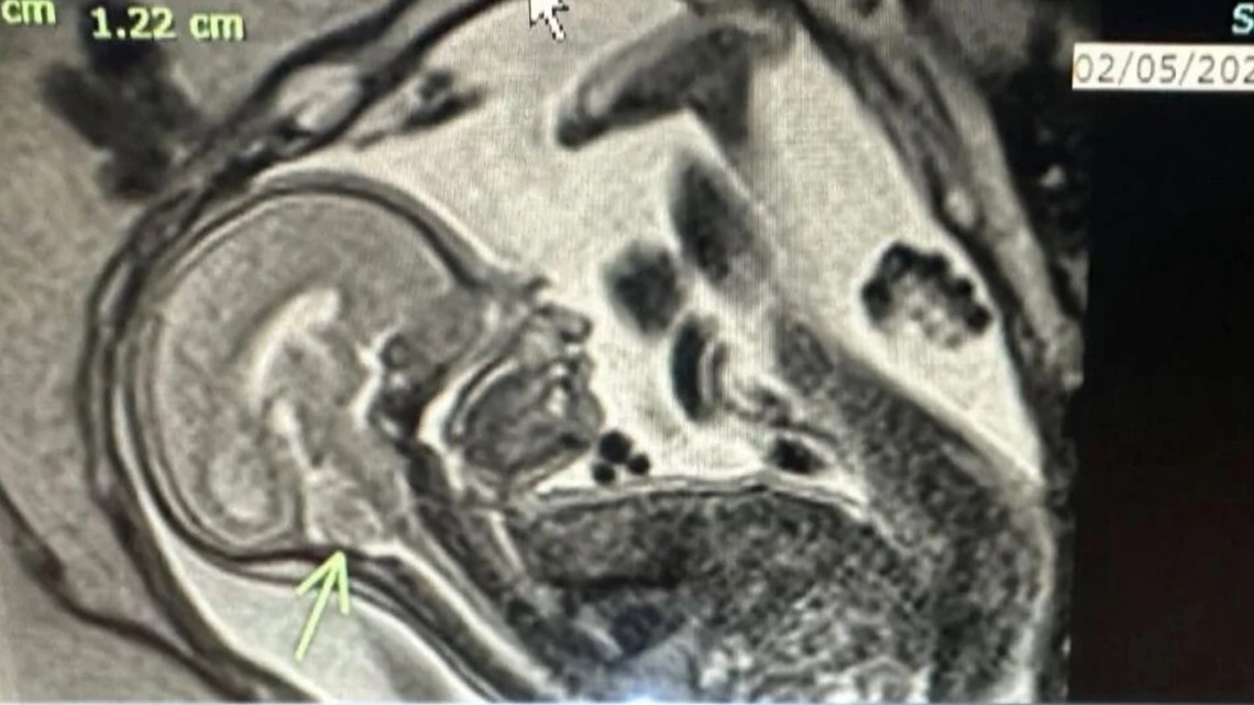 Doctors perform Arizona's first surgery on baby still in womb | 12news.com