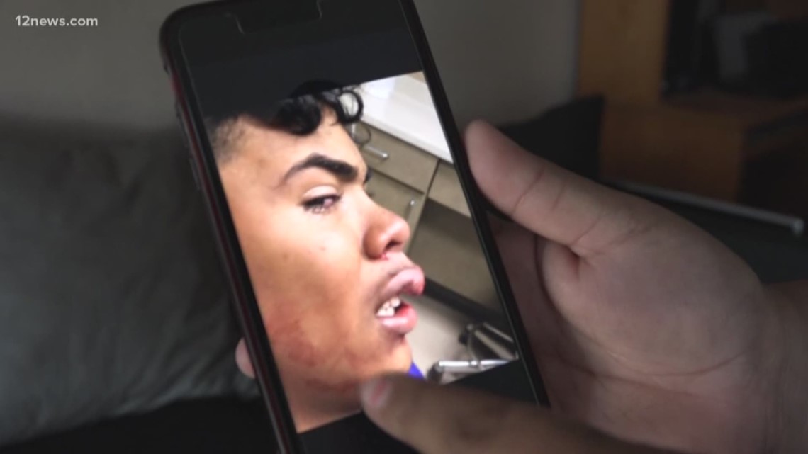 Phoenix teen hit in face with baseball bat at school, gets 12 stitches ...