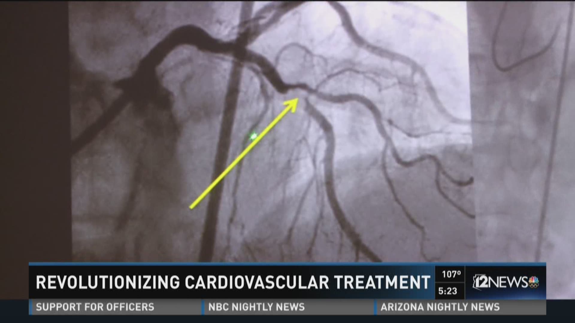 Scottsdale man receives first dissolvable stent implant | 12news.com