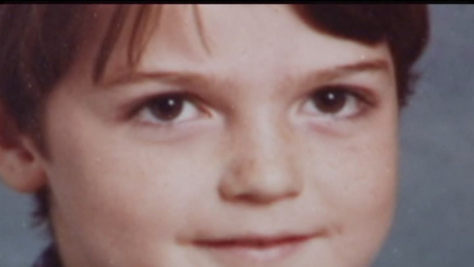 After surviving first-ever face transplant, man needs another medical ...