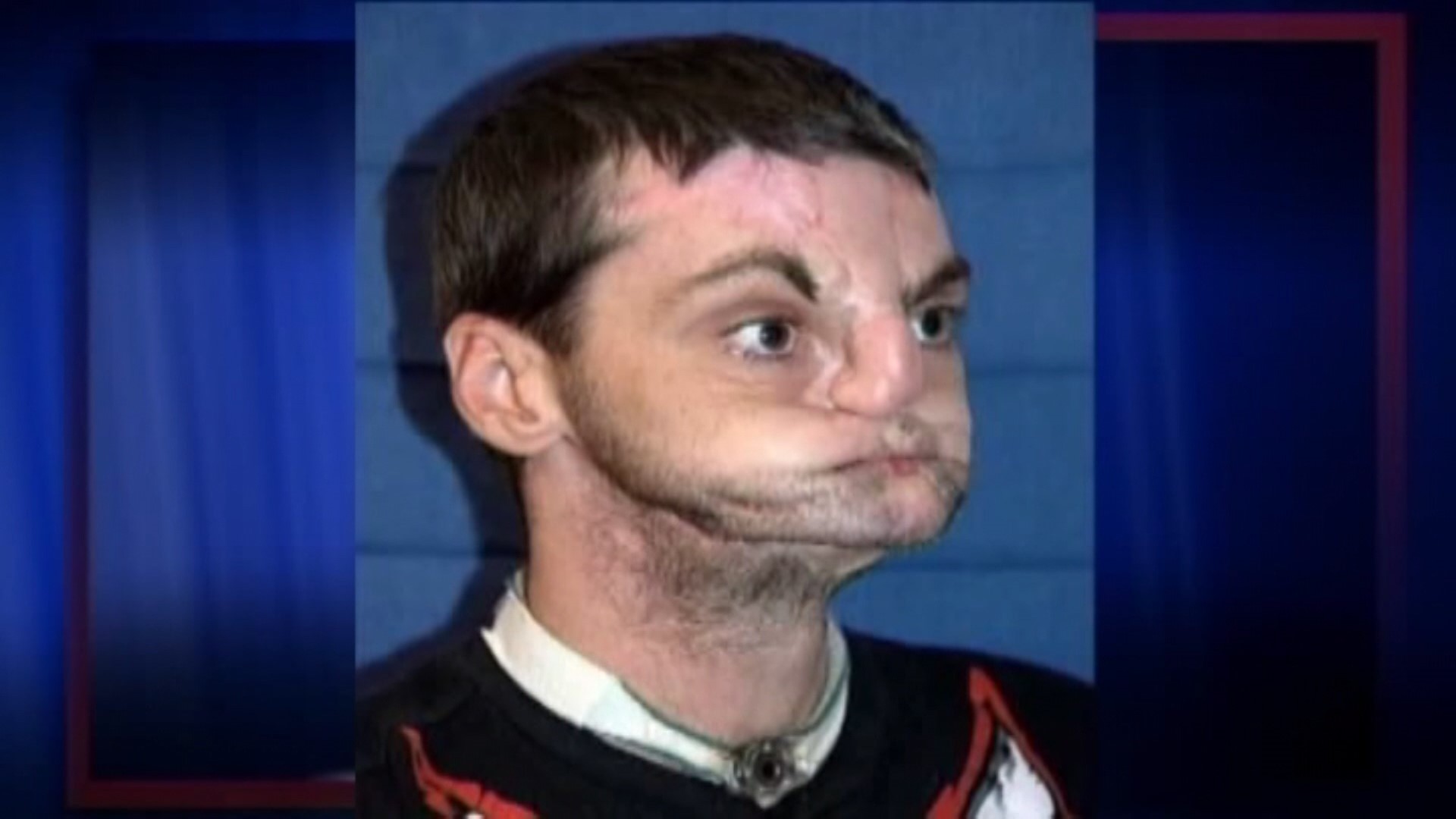 After surviving first-ever face transplant, man needs another medical ...